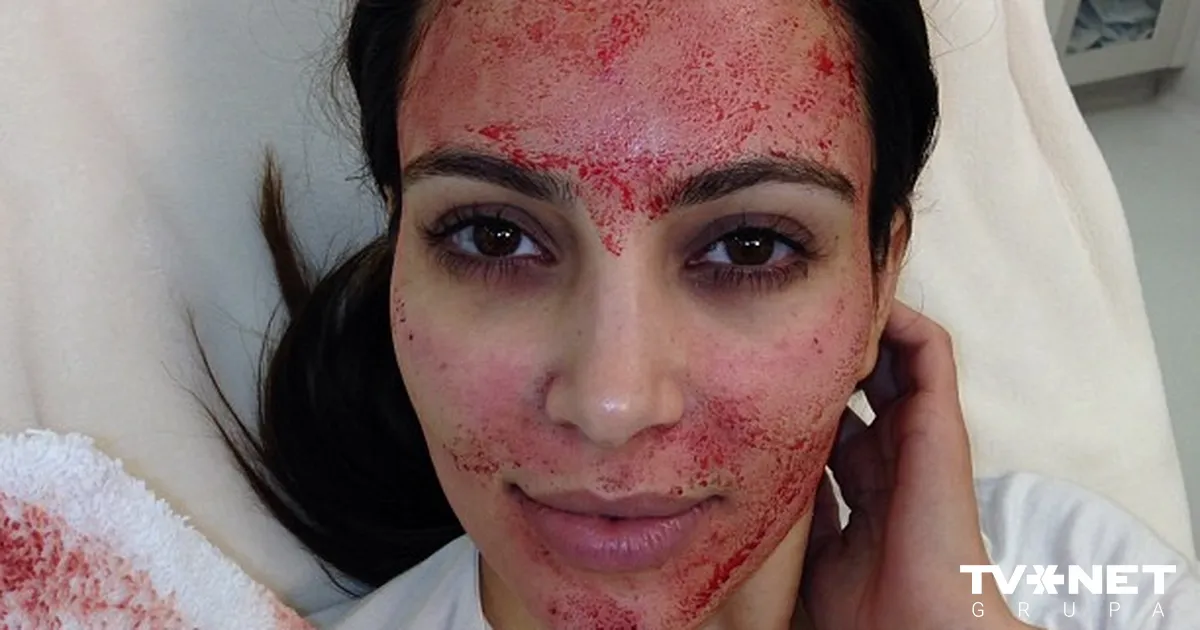 **Option 1 (Focus on intrigue/curiosity):** Reality Star's SHOCKING Vampire Facial: What ...