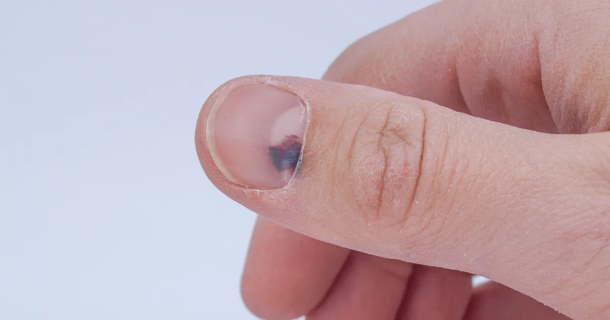 Mustaks tõmbunud küüs võib viidata tõsisele tervisehädale